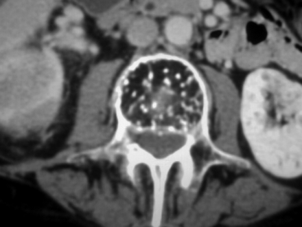 ABC Radiology Blog: The Polka-Dot Sign