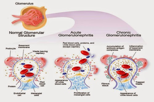 GLOMERULONEFRITIS - PUTRA NUSANTARA