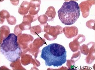 fichero hematologia: Macroglobulinemia de Waldenström