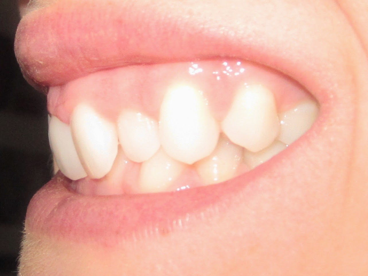 Creatively Titled Blog about Invisalign: August 2014