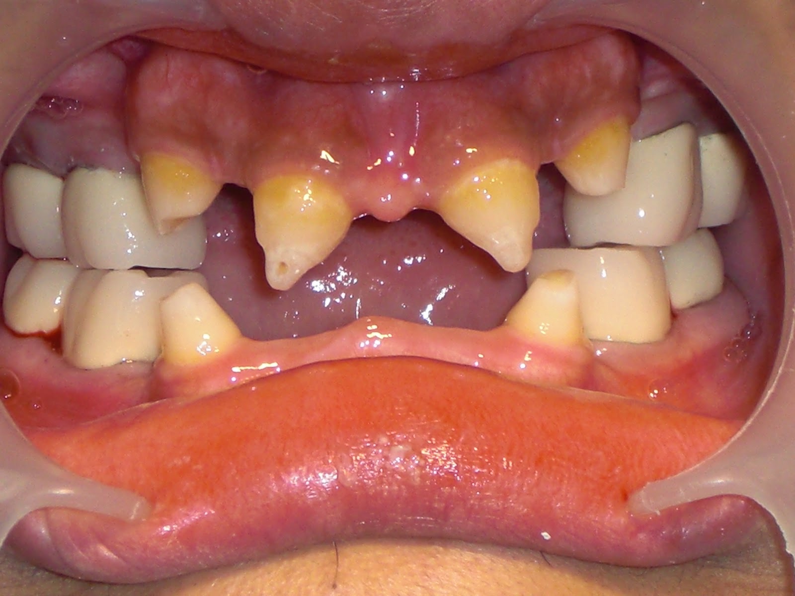 Dental Implantology: MOSTDI REPLACEMENT OF MISSING UPPER LATERALS