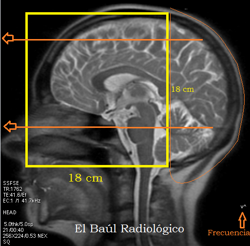 El Baúl Radiológico: ARTEFACTOS POR SUPERPOSICIÓN EN EL SENTIDO DE LA ...