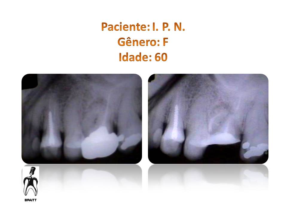 Endodontia Dr. Henrique Braitt: Tratamento endodôntico em dente com ...