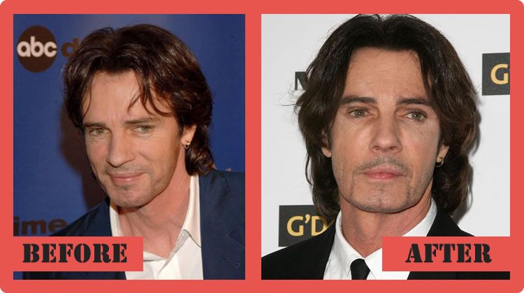 Rick Springfield Plastic Surgery Blog: June 2015