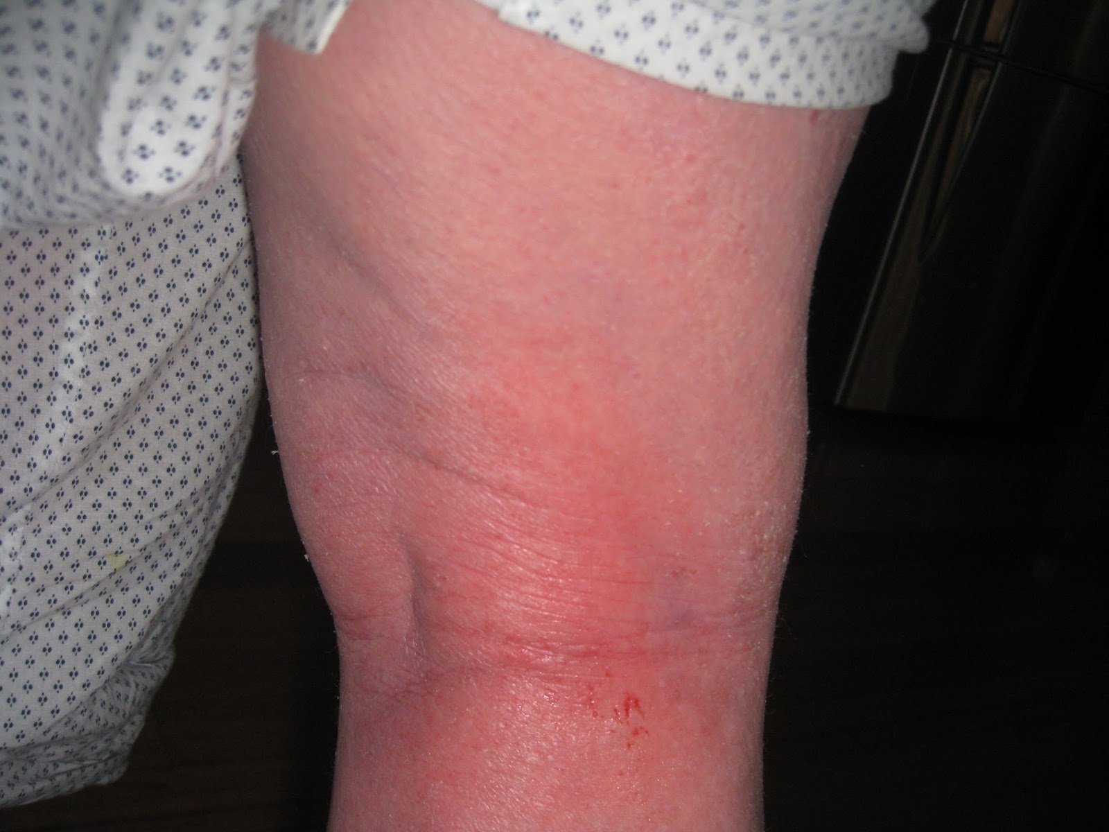 Topical Steroid Withdrawal Journey-Healing Eczema and Red Skin Syndrome