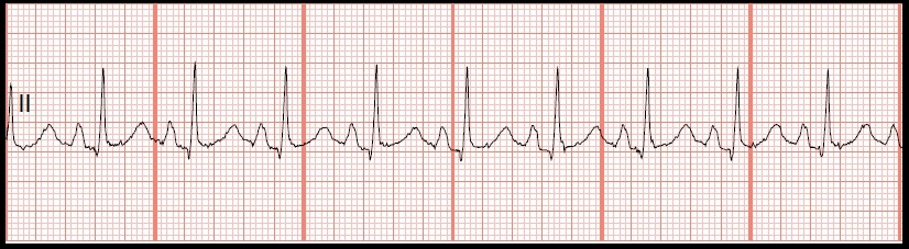 EKG Rhythm Strip Quiz 147: Interval Measurements