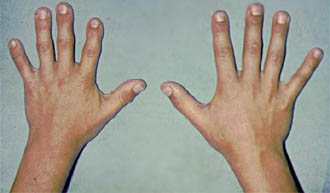 MALFORMACIONES CONGENITAS