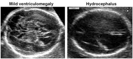 hydrocephalie: IX. Diagnostic d'hydrocéphale fœtale