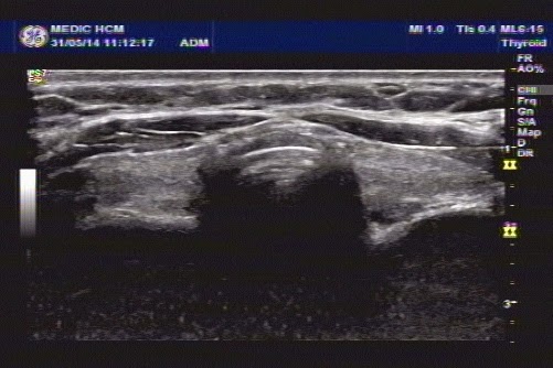 VIETNAMESE MEDIC ULTRASOUND: CASE 290: PARACERVICAL SPINE ABSCESS: Dr ...