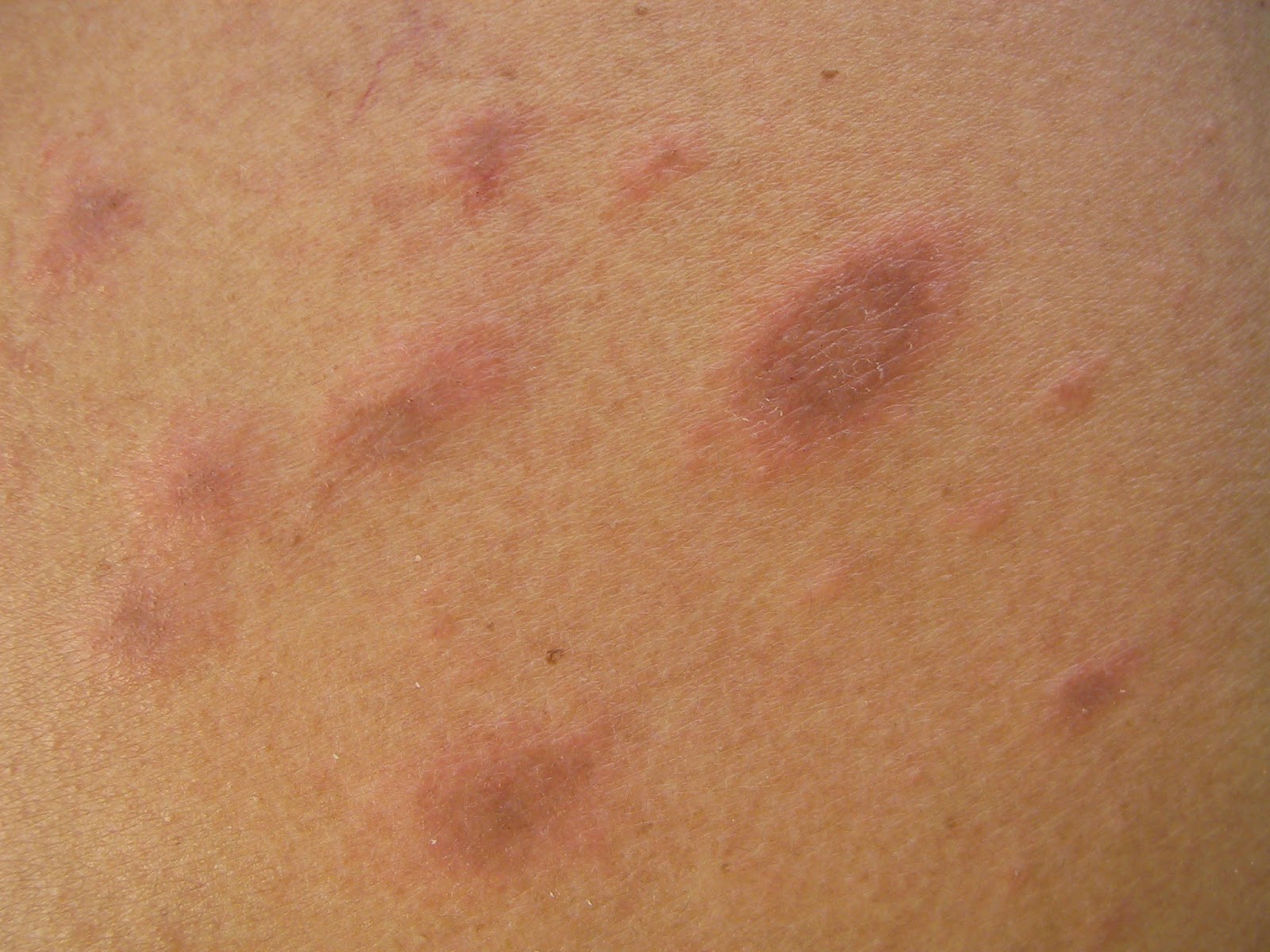 My Pityriasis Rosea Blog I Have Pityriasis Rosea