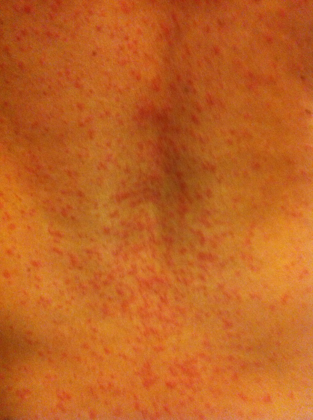 eyes peeled, always: Revlimid Rash Out