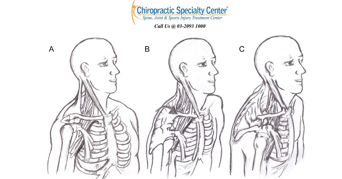Common Causes of Thoracic Outlet Syndrome in Malaysia
