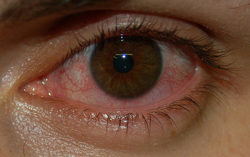 Easy Ways to Overcome the Red Eye | Beautiful Ala Indonesian