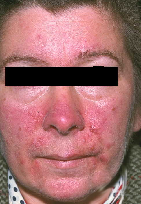 Dermatitis seborreica