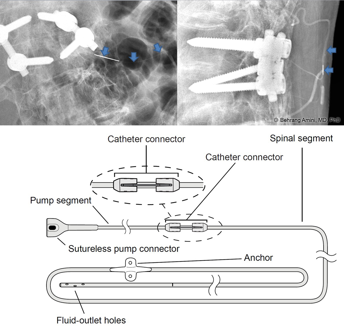 Roentgen Ray Reader: Radiographic Appearance of the Ascenda® 8780 and ...