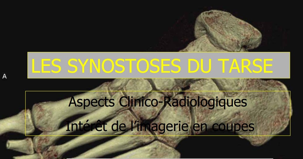 Ma bibliothèque en Imagerie Médicale: SYNOSTOSE DES OS DU TARSE