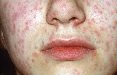 Measles rash on the face of a patient