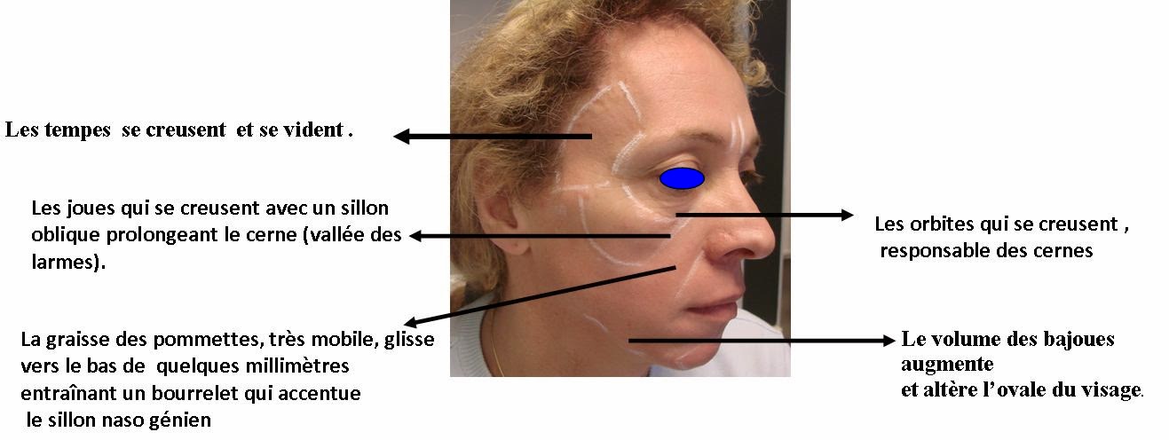 LE SILLON NASOGÉNIEN, LA LIMITE HAUTE DU SOURIRE