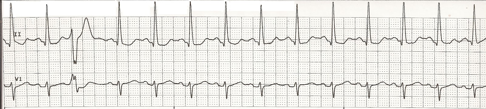 EKG Rhythm Strip Quiz 48