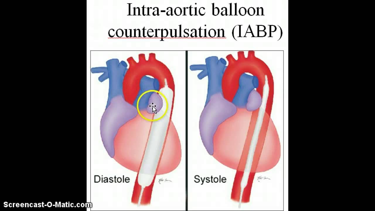 Intraaortic Balloon