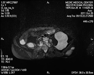 MRI MEDIC CASE STUDIES COLLECTION: Pott' disease and thigh abscess.