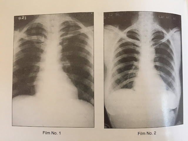NORMAL VARIANT OF CHEST XRAY