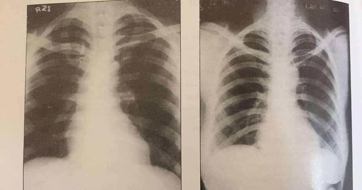 NORMAL VARIANT OF CHEST XRAY