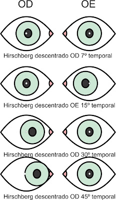 Optometria in Foco: Teste de Hirschberg