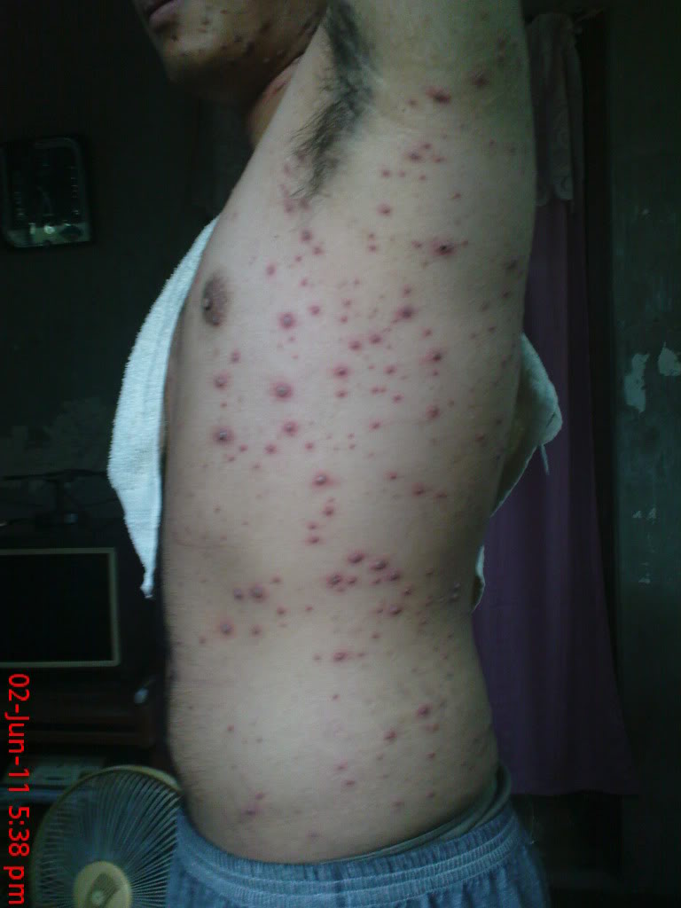 bulutong - philippin news collections