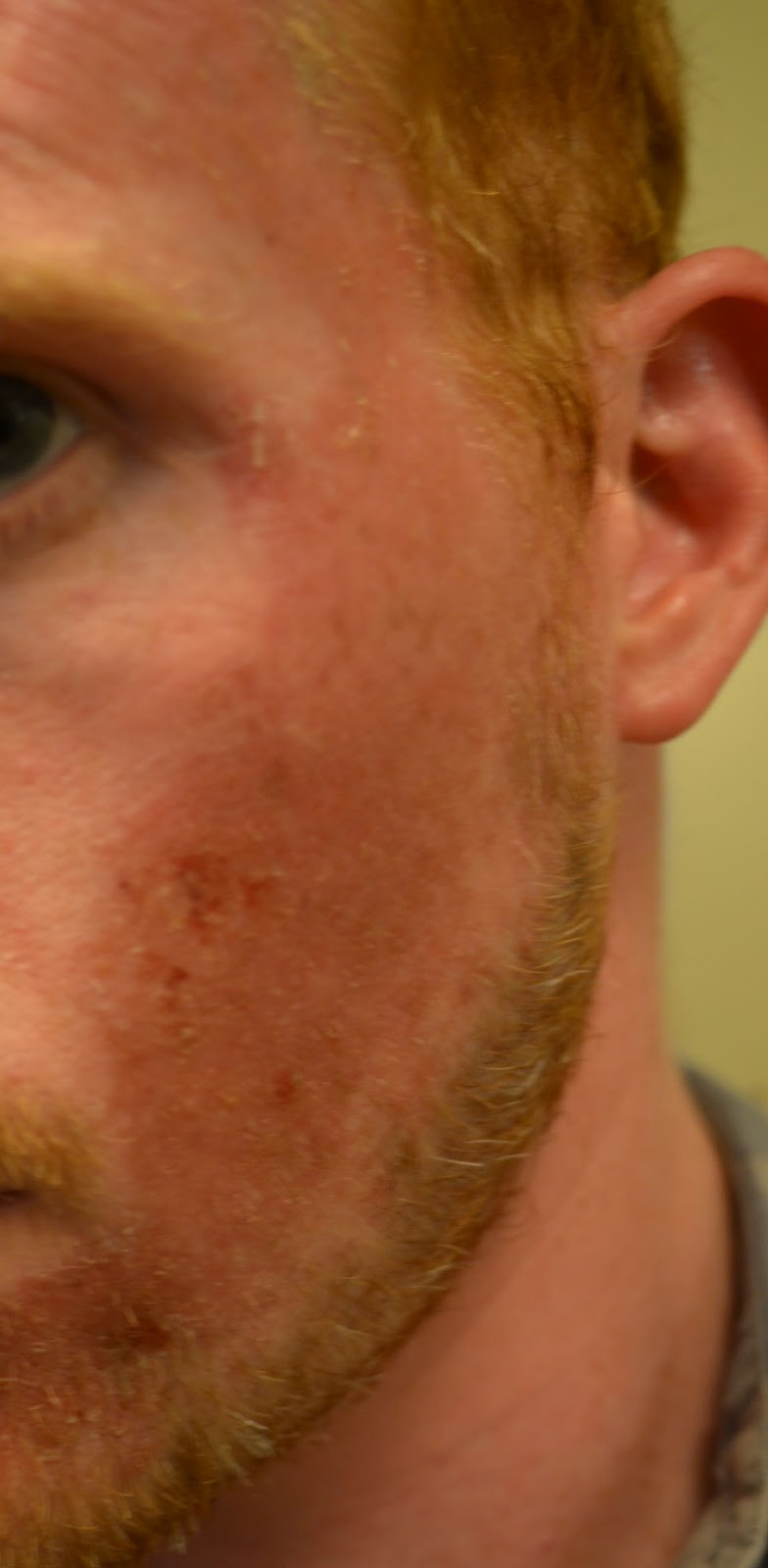 27 Years of Nothing but Failures: Fun with Skin Cancer Part 2!