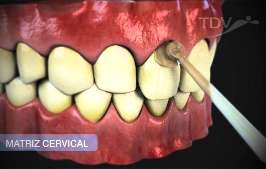 MATRIZ CERVICAL TDV - Restaurações classe V - Odonto-Tv