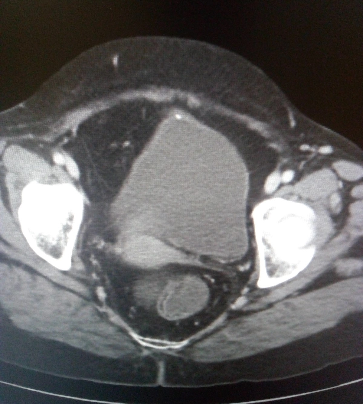 Urachal Anomaly: Case Reports - Sumer's Radiology Blog