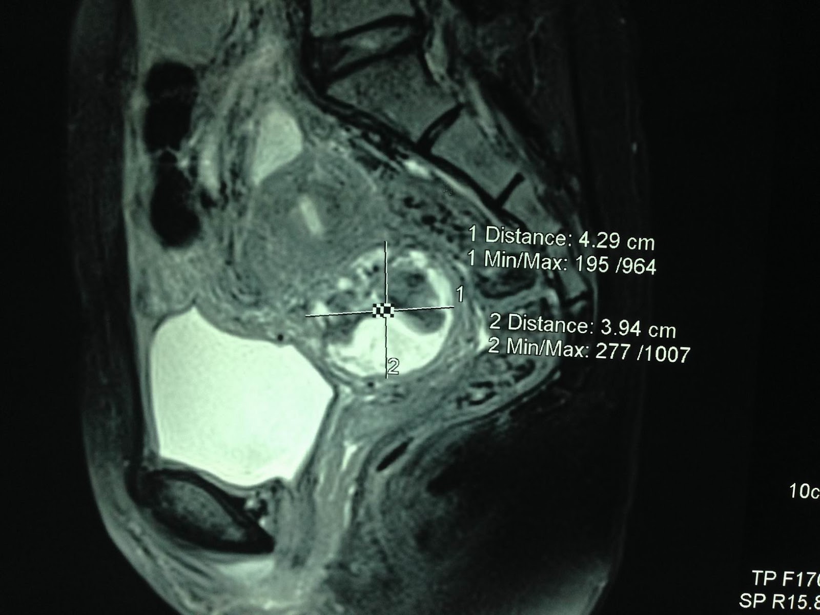 VIETNAMESE MEDIC ULTRASOUND: CASE 375: UTERUS MASS, Dr PHAN THANH HẢI ...
