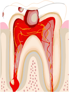 Pulpitis or Toothache | Symptoms and Treatment for Pulpitis or ...