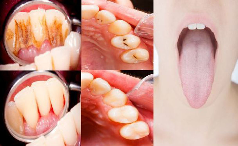 Complete Guides How to Remove Tartar and Plaque, Heal Cavities and ...