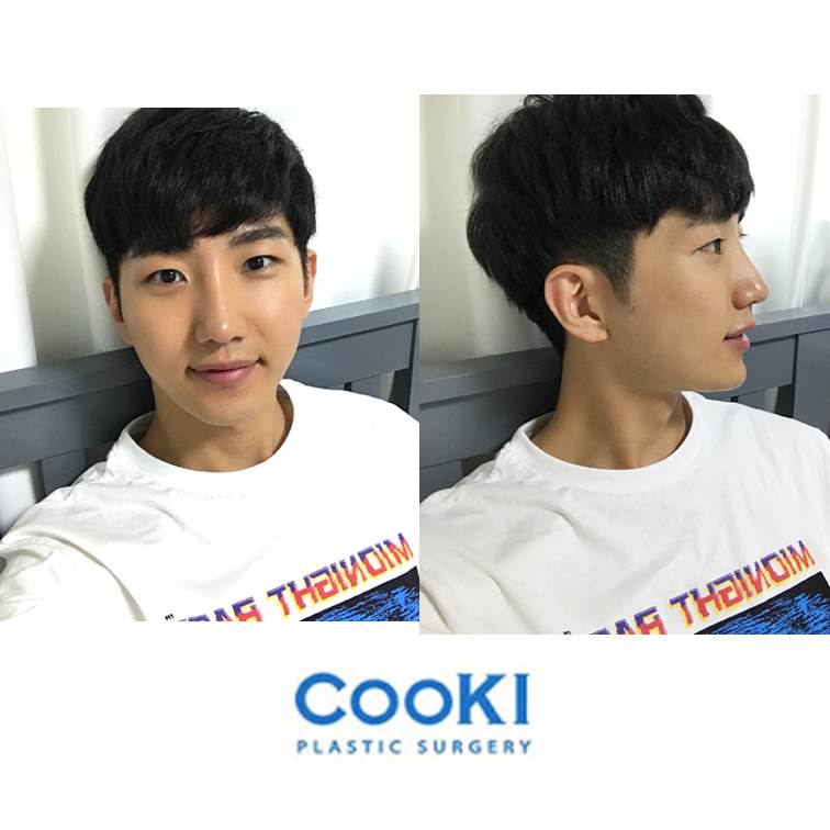 SQUARE JAW, CHEEKBONE and CHIN SURGERY for men