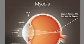 What is the Myopia Disease?