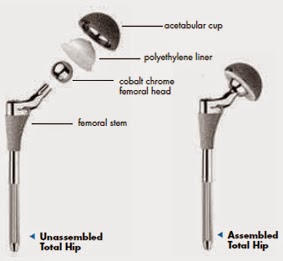 Medical Treatment Pictures-for Better Understanding: Partial Hip ...