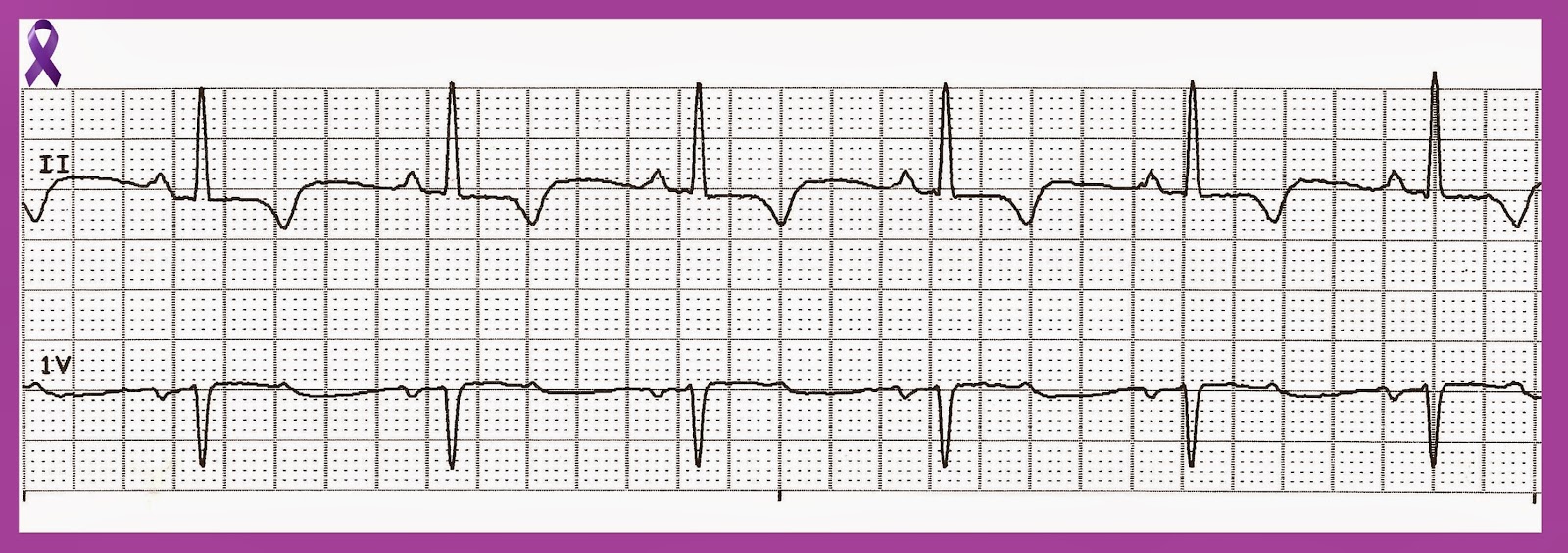 Practice EKG Strips 358