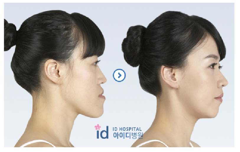 ID Hospital Korea: [korea plastic sugery] long face surgery(before and ...