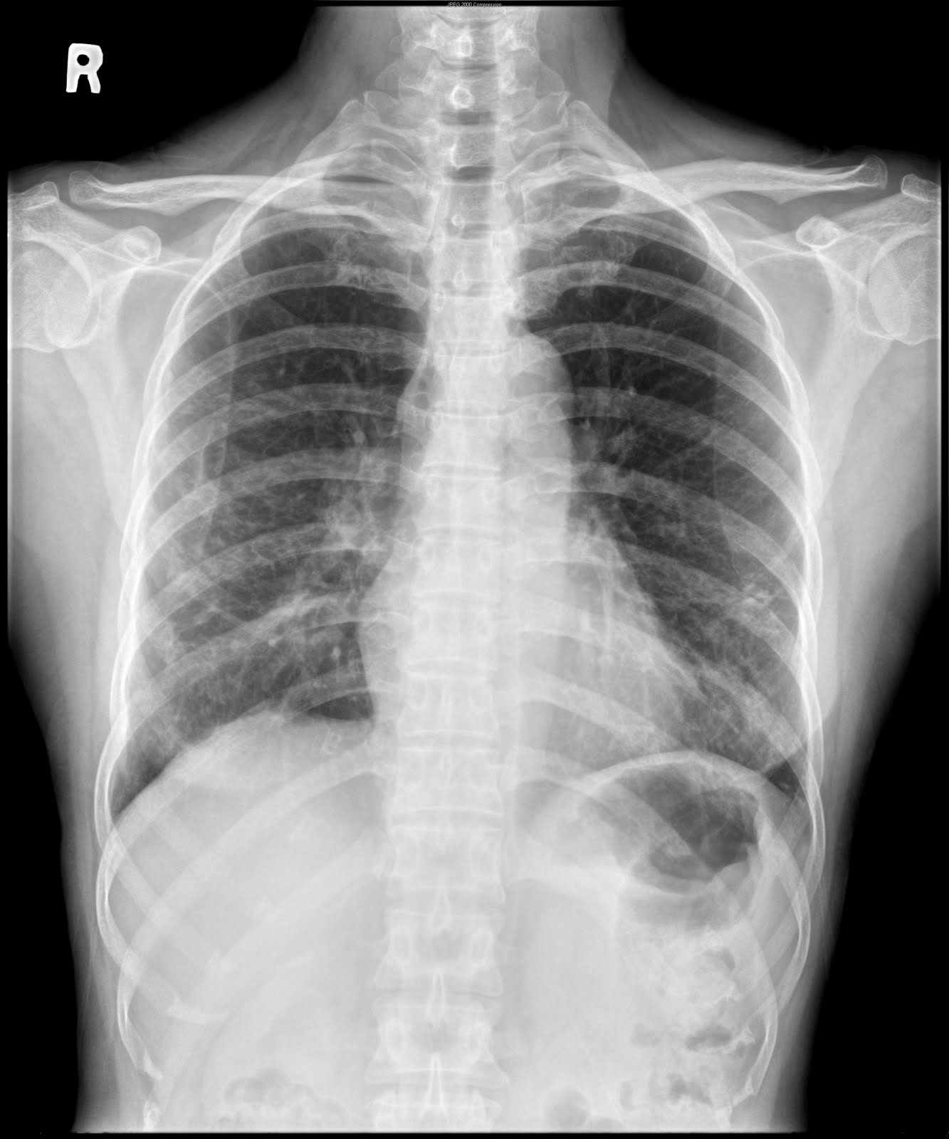 CXR 胸部x光判讀 tuberculosis