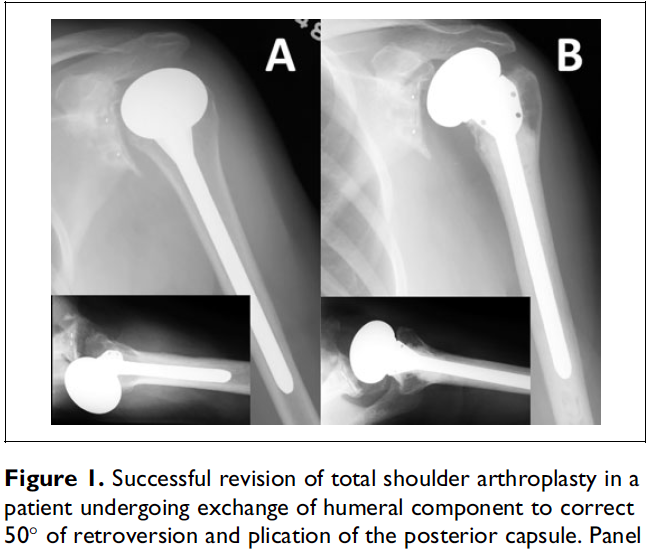 Shoulder Arthritis/Joint Replacement Rotator cuff tears: Failed ...