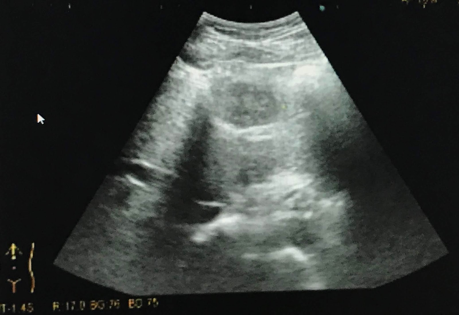 VIETNAMESE MEDIC ULTRASOUND: CASE 517: HCC WITH LOW AFP, Dr PHAN THANH ...