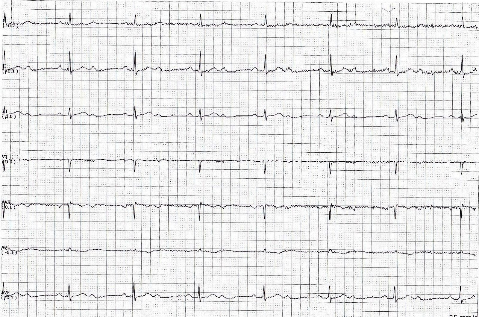 ECG Rhythms: A 2:1 AV block is not right away a Mobitz II