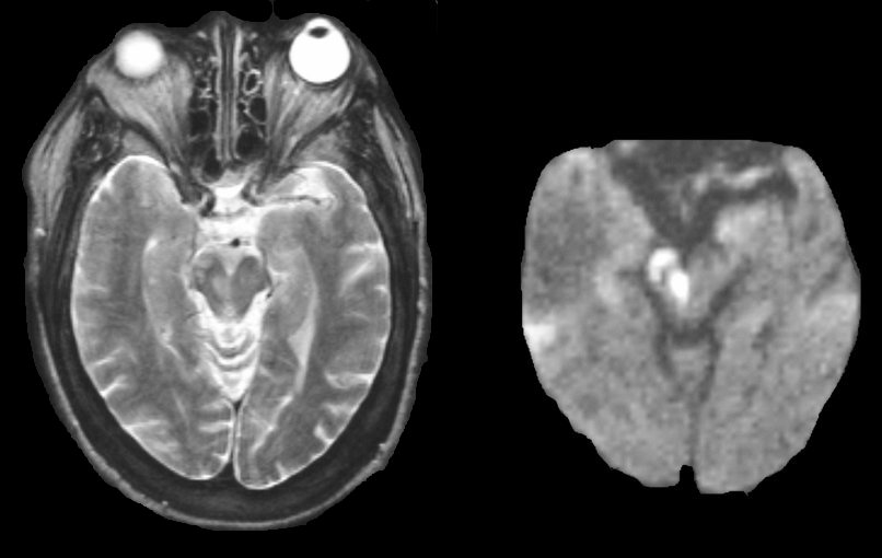 Dr Balaji Anvekar FRCR: Ischemic stroke and Vascular territories of Brain