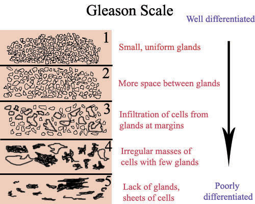 Science Doing: Benign Prostatic Hyperplasia could be Adenocarcinoma ...
