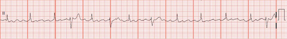 EKG Rhythm Strips 25: Ectopic beats