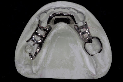 Boise Idaho Prosthodontics: Semi-Precision attachment RPD - 3 different ...