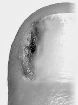 Onychia Causes, Treatment and Small Home Remedy