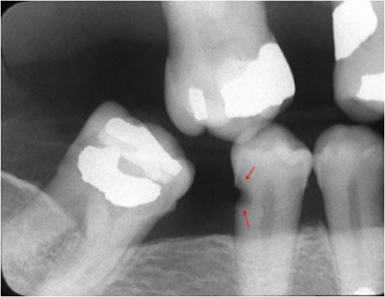 Dentistry and Medicine: Dental Caries definition, Classification of ...